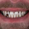 Turkey Teeth: Affordable Smile Makeovers in Turkey
