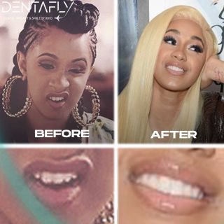 Cardi B Teeth Transformation: Before, After & Procedure Explained ...